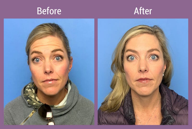 BOTOX® Cosmetic | Allura Skin, Laser & Wellness Clinic | Fort Collins ...